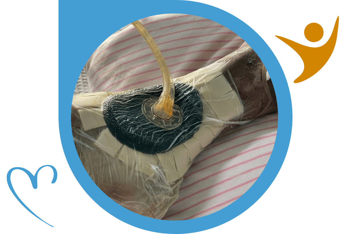 Advanced Negative Pressure Wound Therapy in Quezon City – Kalingap ...
