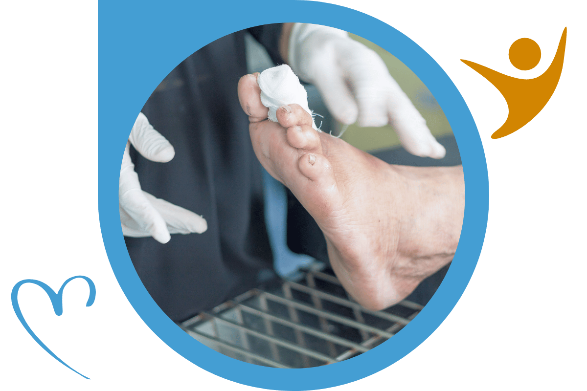 Comprehensive Diabetic Foot Ulcer Management in Quezon City – Kalingap ...