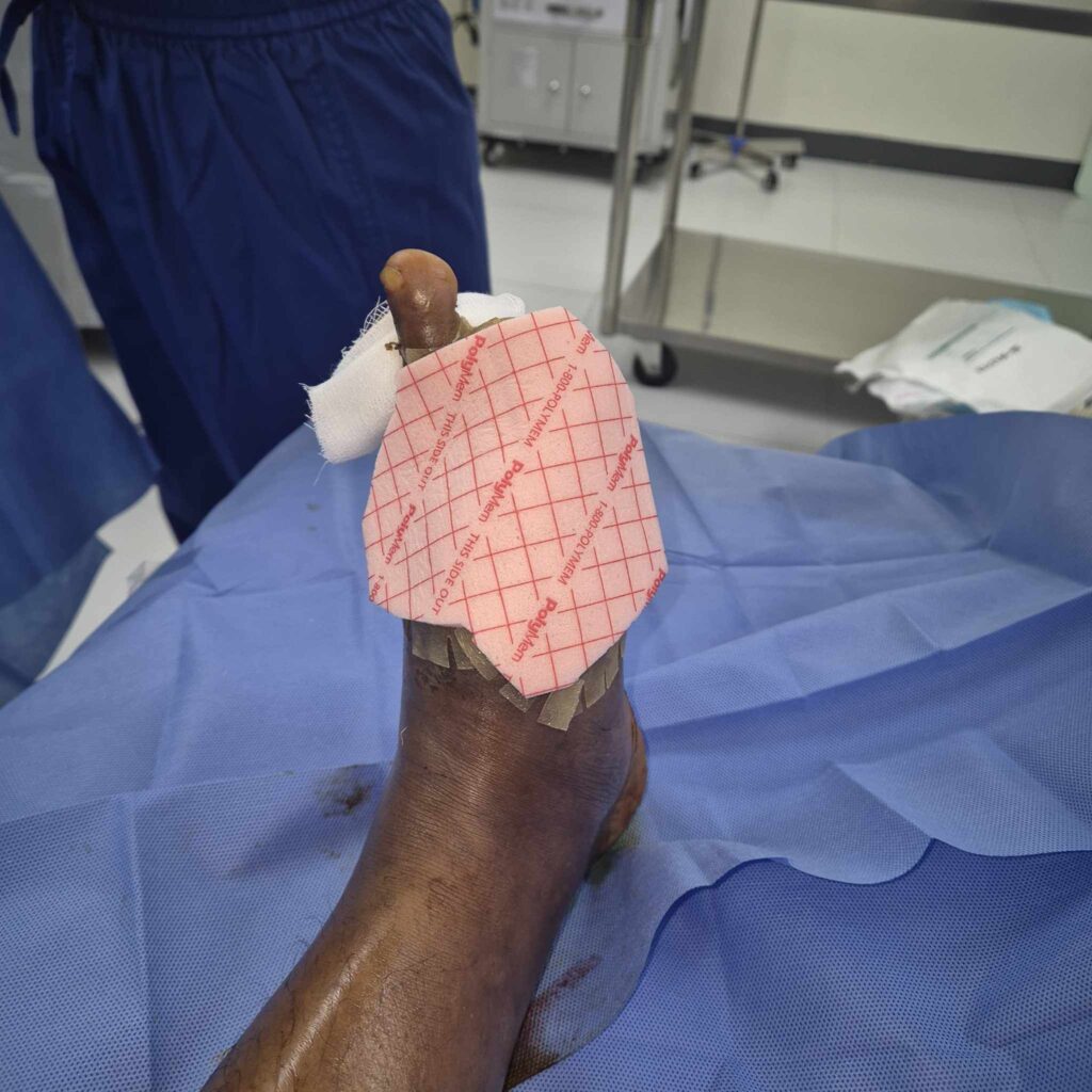 Wound Debridement Services in the Philippines - Kalingap