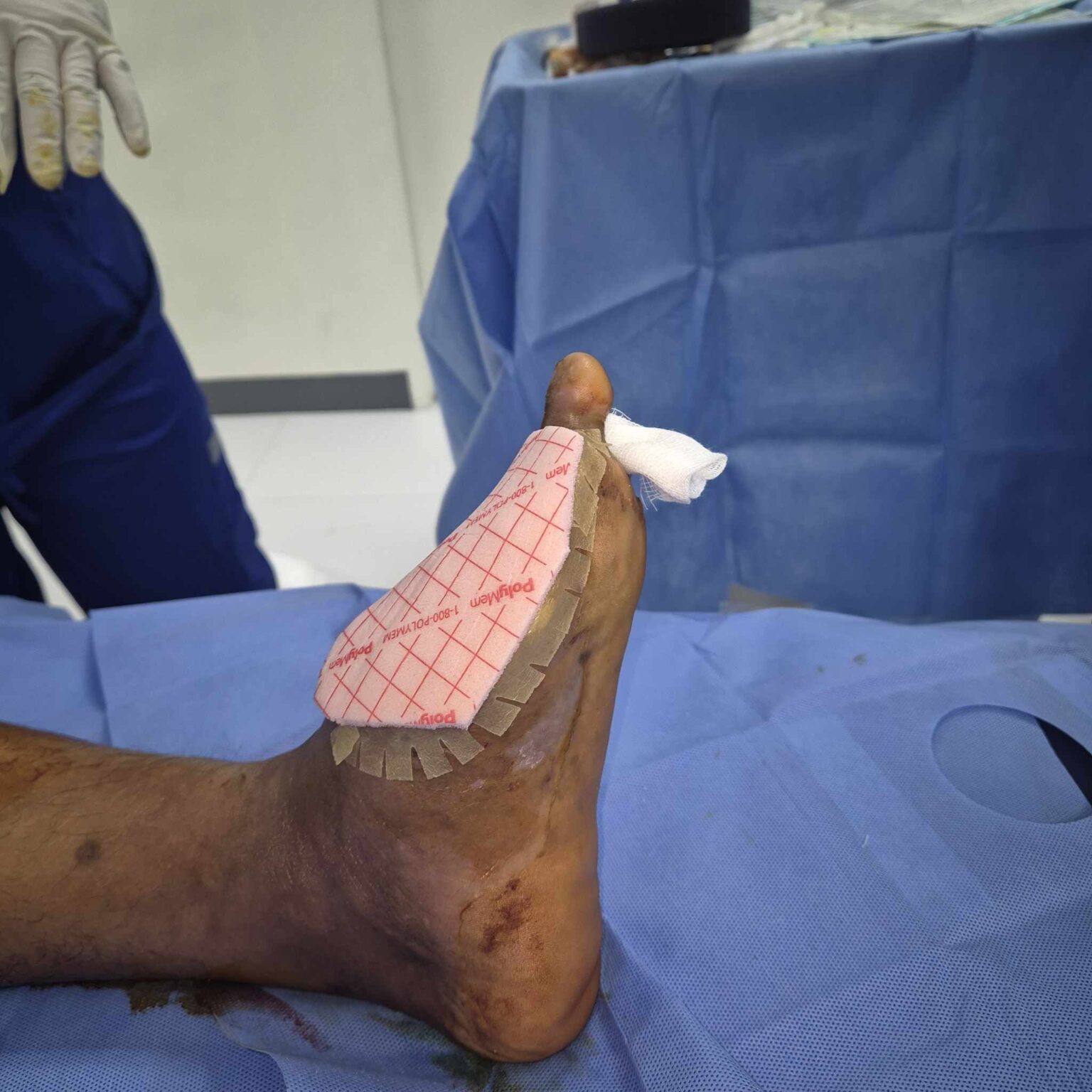 Wound Debridement Services in the Philippines - Kalingap